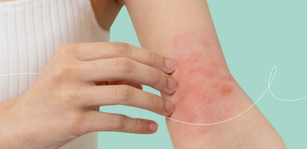 Dermatite atopica tra cause, sintomi e serena convivenza - Ontherapy®