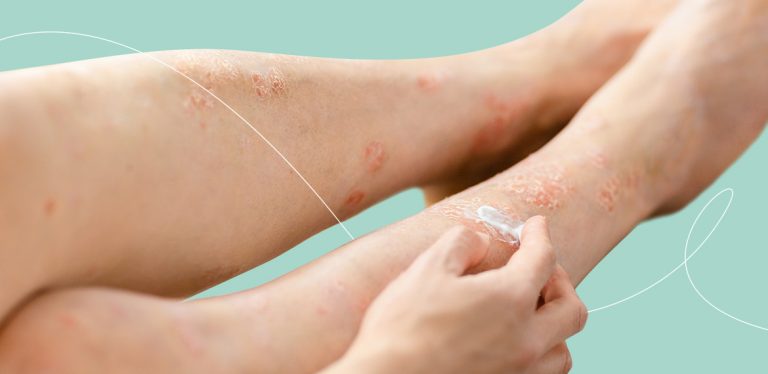 Dermatite da stasi: tutto ciò che si deve sapere - Ontherapy®